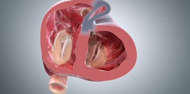 Hybrid Approach to Reshaping Left Ventricle Offers Hope for HF Patients ...